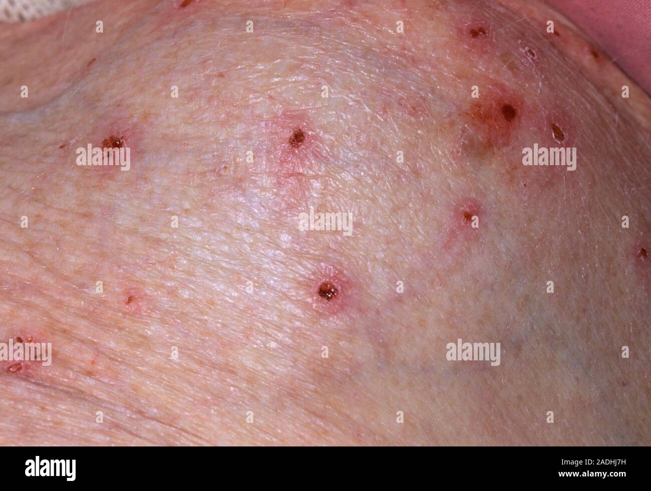 Kidney failure. Scratch marks on the skin of an 83-year-old man with ...
