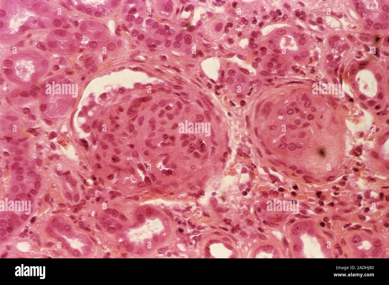 Kidney inflammation. Light micrograph of kidney tissue in a case of ...