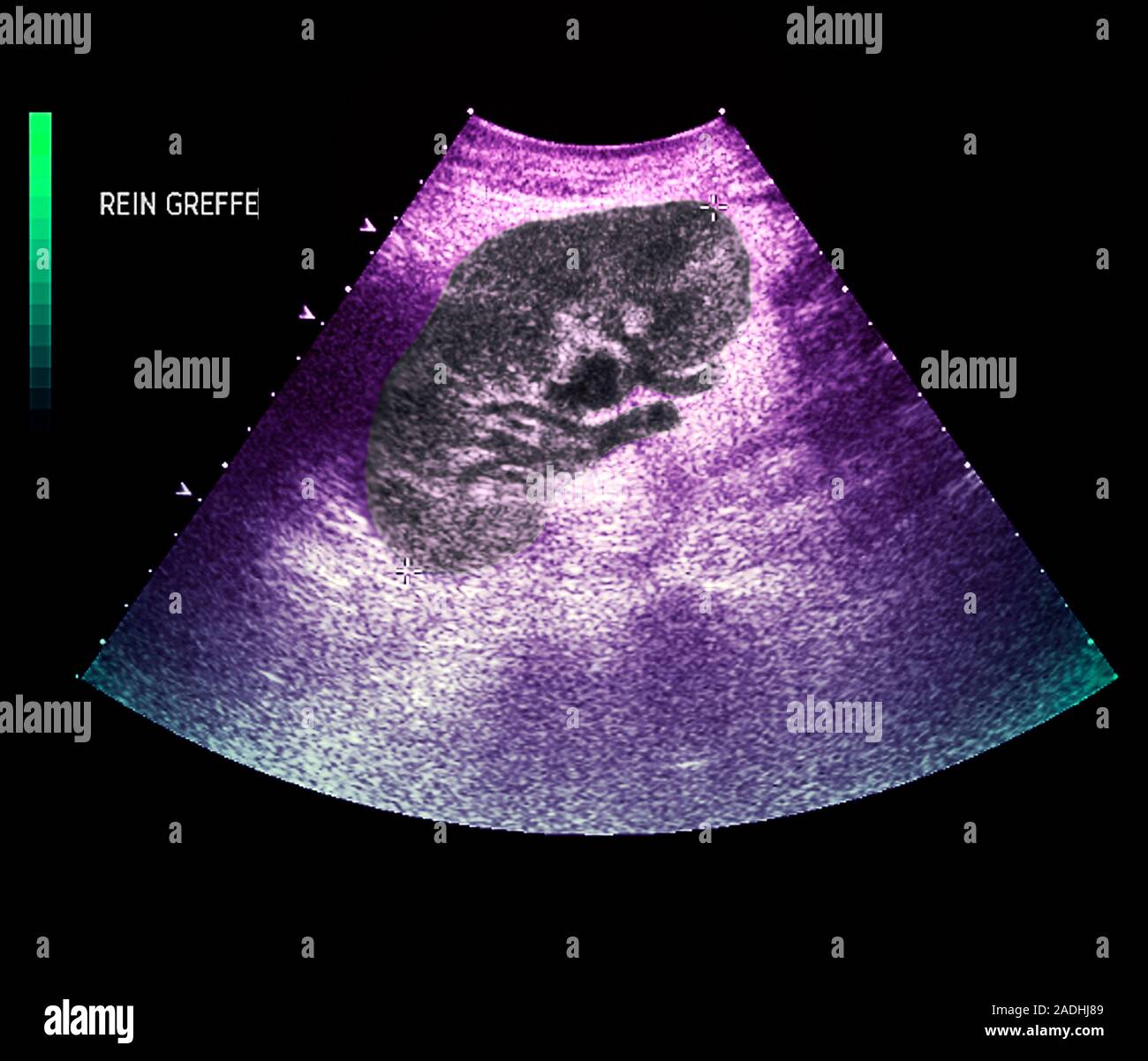 Transplanted kidney. Coloured ultrasound scan of a transplanted kidney ...