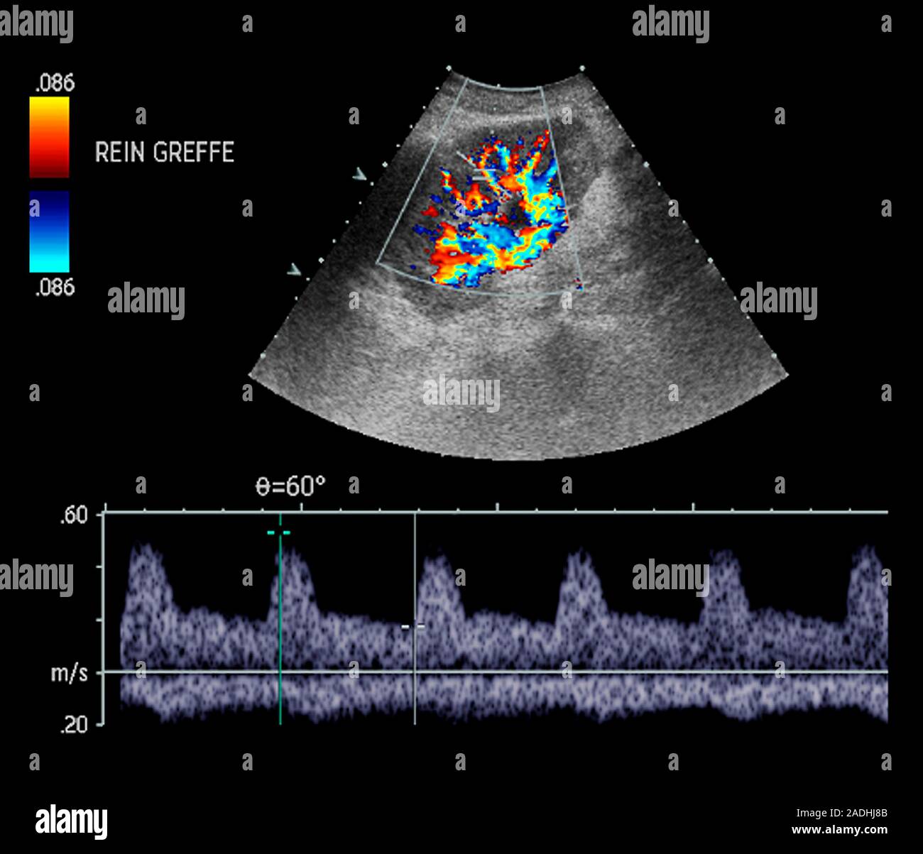 Transplanted kidney. Colour doppler ultrasound scan of a transplanted ...