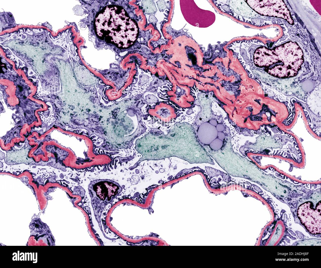 Kidney disease. Coloured transmission electron micrograph (TEM) of a ...