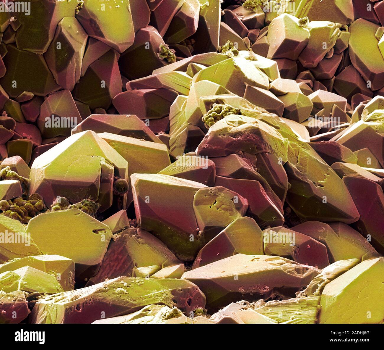 Bladder stone. Coloured scanning electron micrograph (SEM) of the ...