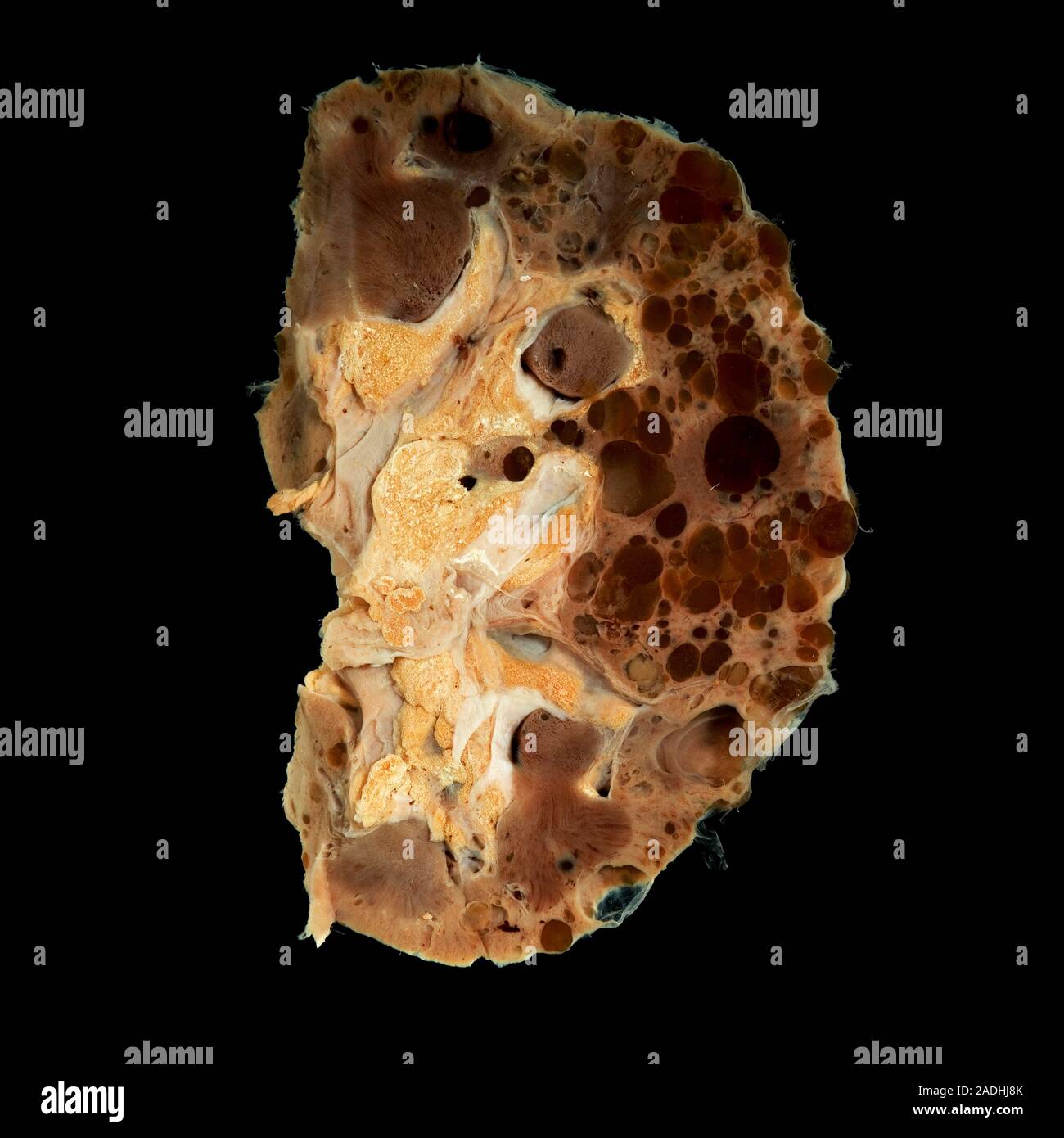 Polycystic kidney. Cross-section through a polycystic kidney. The ...