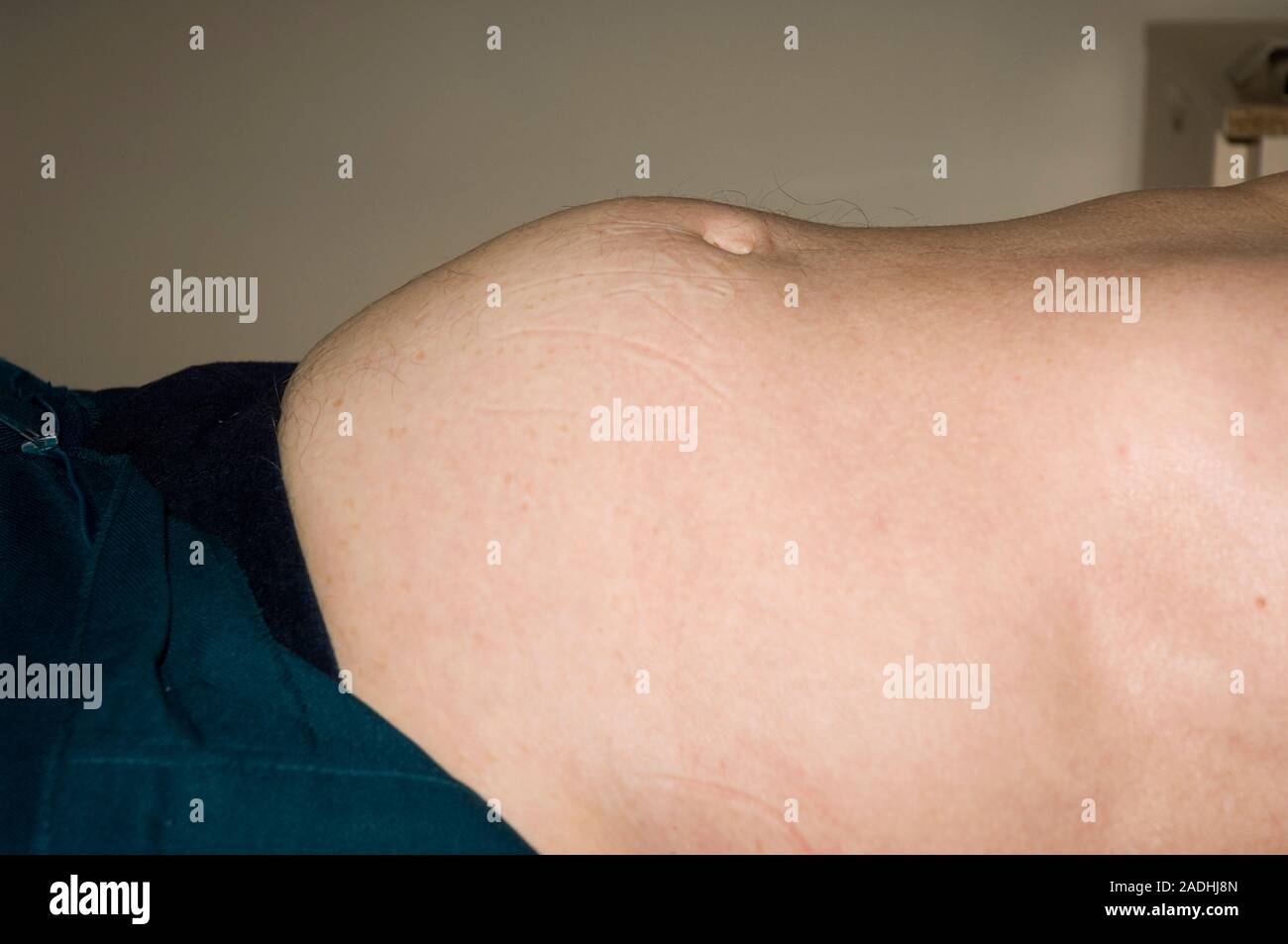 MODEL RELEASED. Urine retention. Distended abdomen of an 85 year old ...