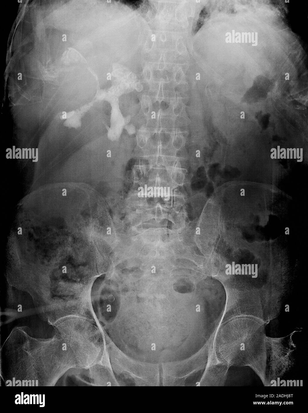 Staghorn kidney stone. X-ray of the abdomen of a patient with a large ...