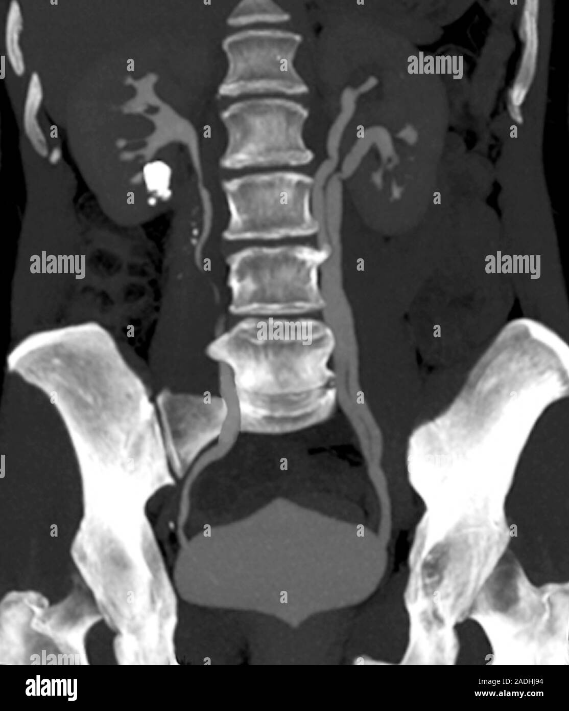 Kidney stones. CT (computed tomography) scan of the abdomen of a 60 ...