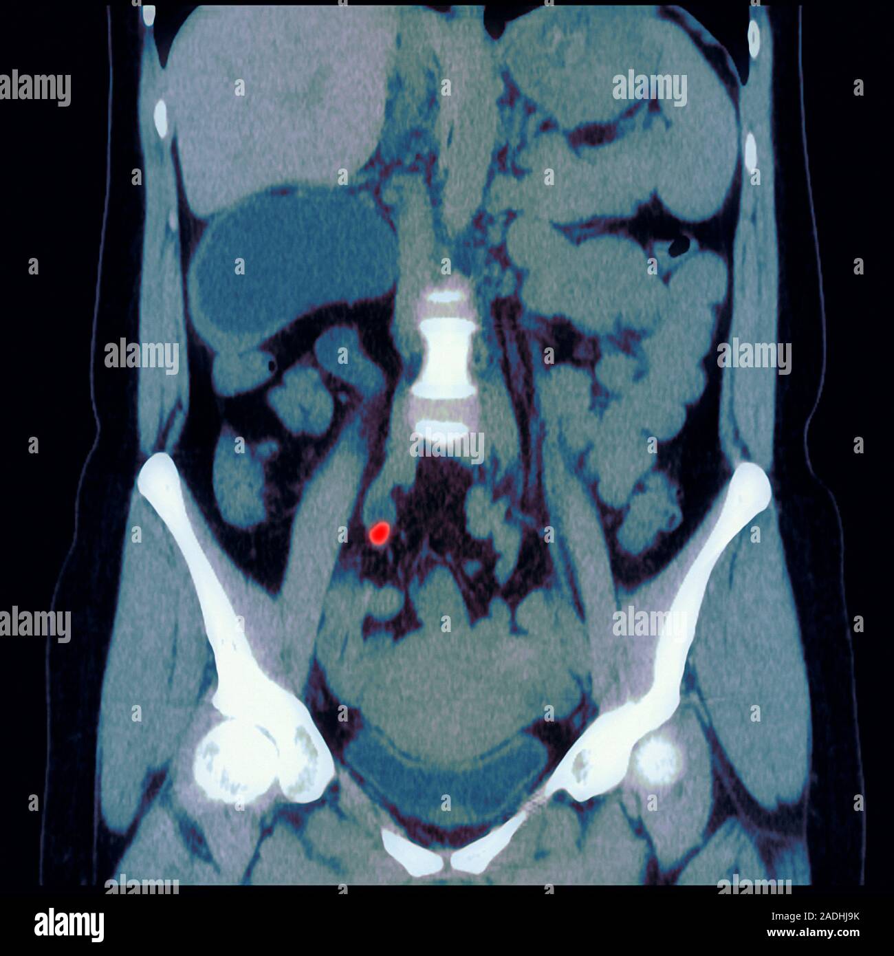Kidney stone. Coloured frontal magnetic resonance imaging (MRI) scan of ...