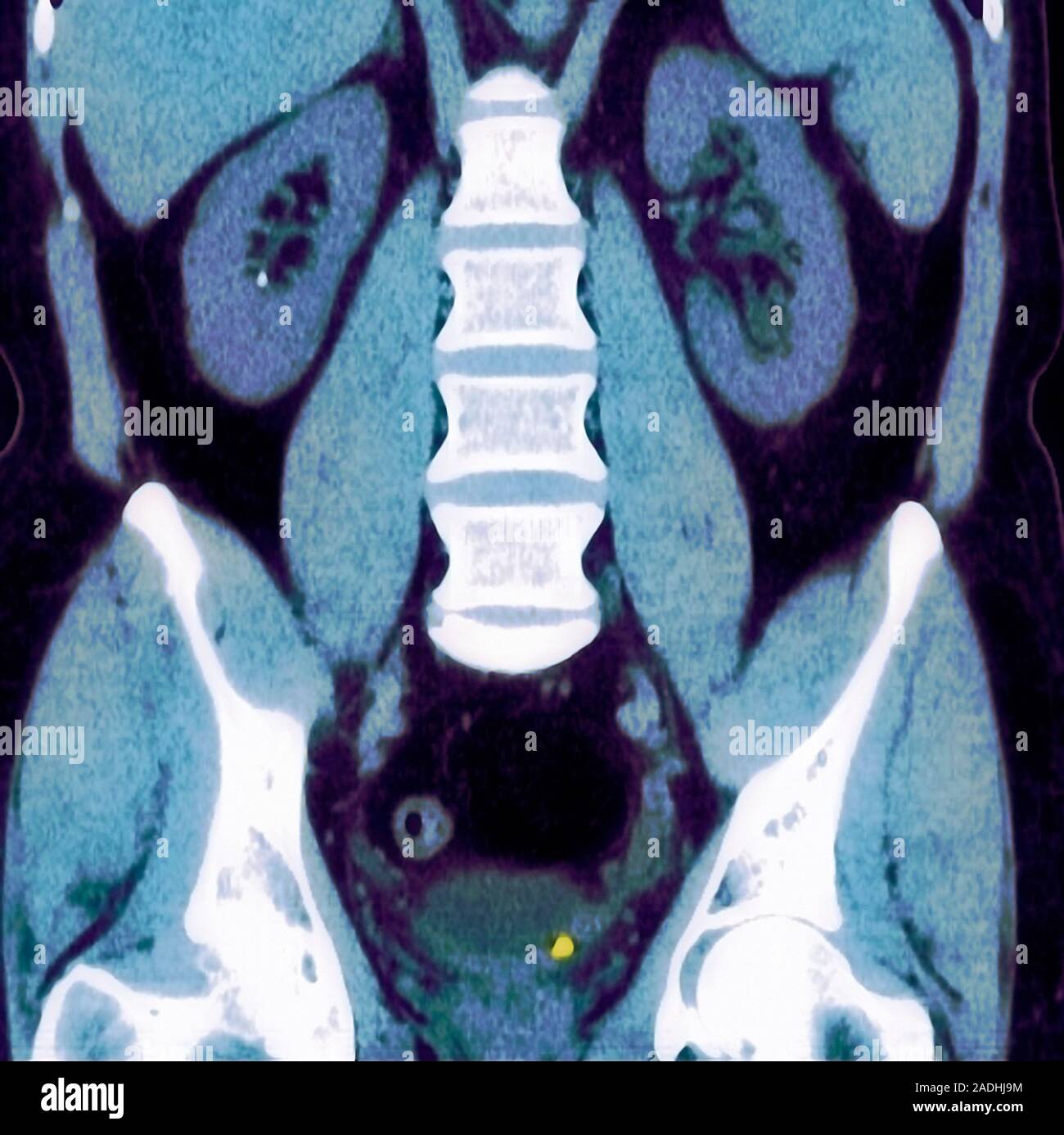 Kidney stone. Coloured frontal magnetic resonance imaging (MRI) scan of ...