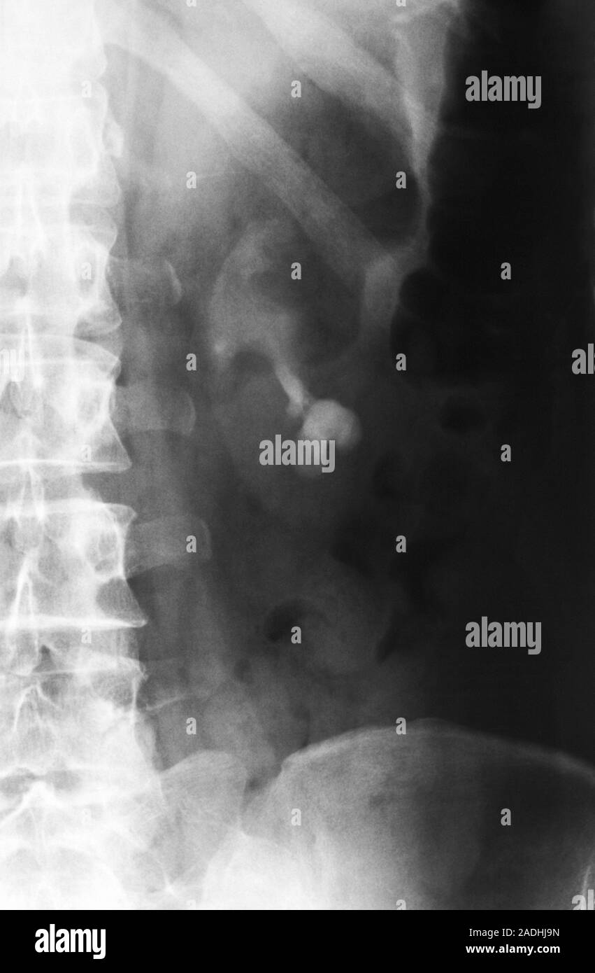 Staghorn kidney stone. X-ray of the abdomen of a patient with a ...