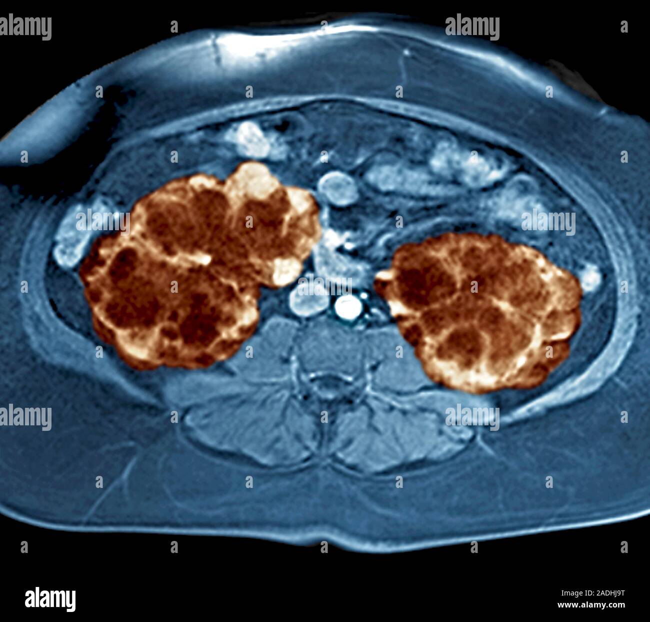 Polycystic kidneys. Coloured magnetic resonance imaging (MRI) scan of ...