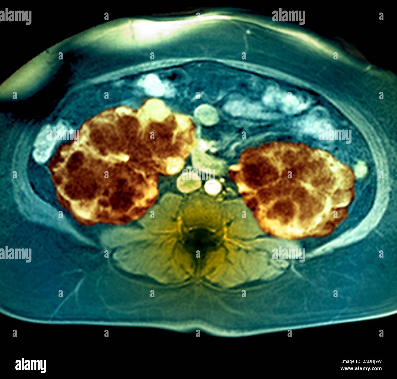 Polycystic kidneys. Coloured magnetic resonance imaging (MRI) scan of ...