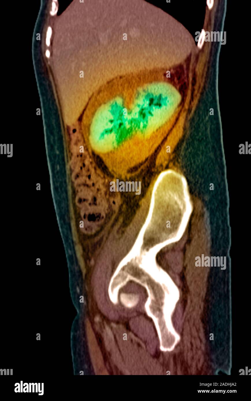 Kidney damage. Coloured lateral computed tomography (CT) scan showing a vertical section through ...