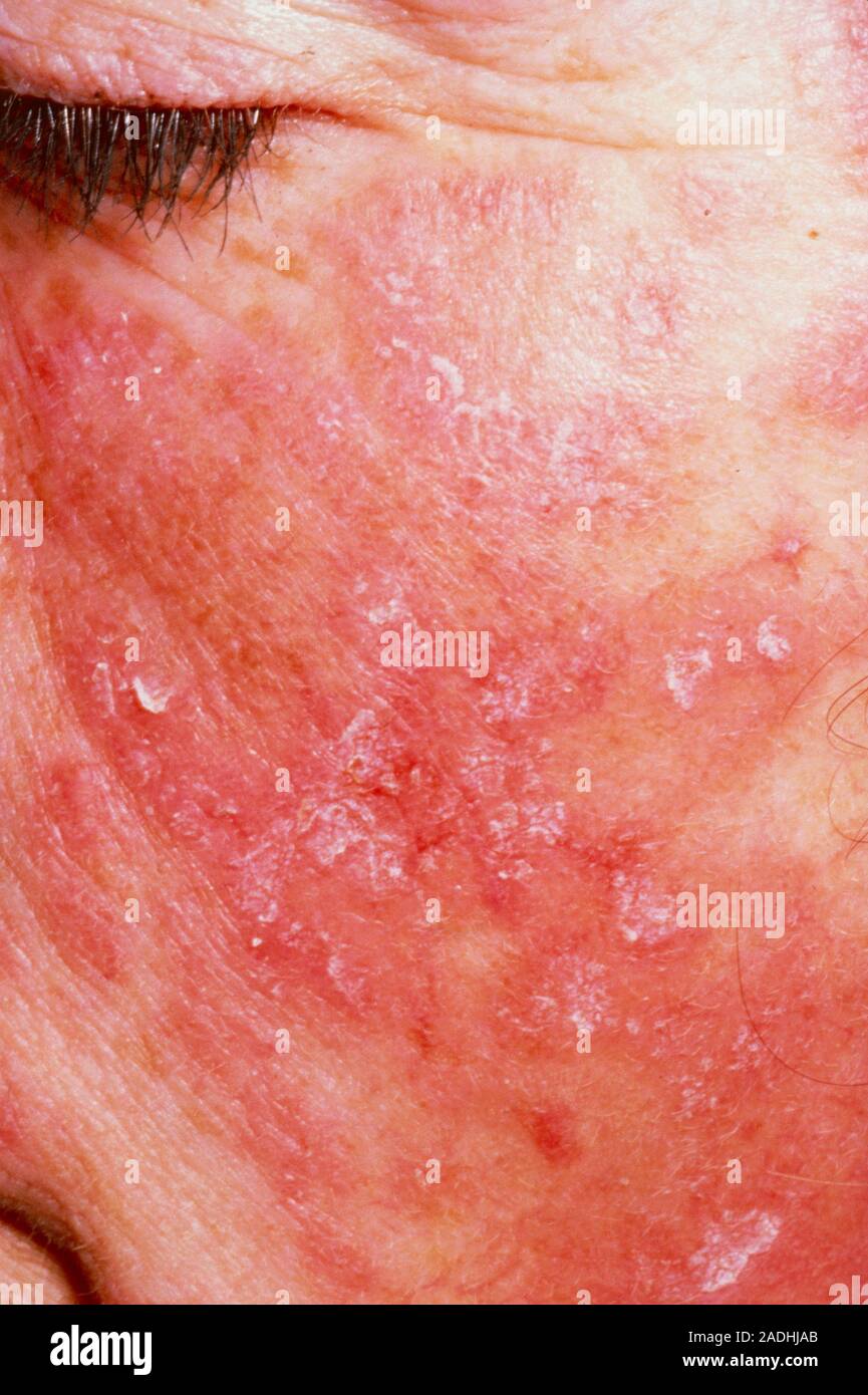 The red scaly rash of systemic lupus erythematosus (SLE) affecting a ...