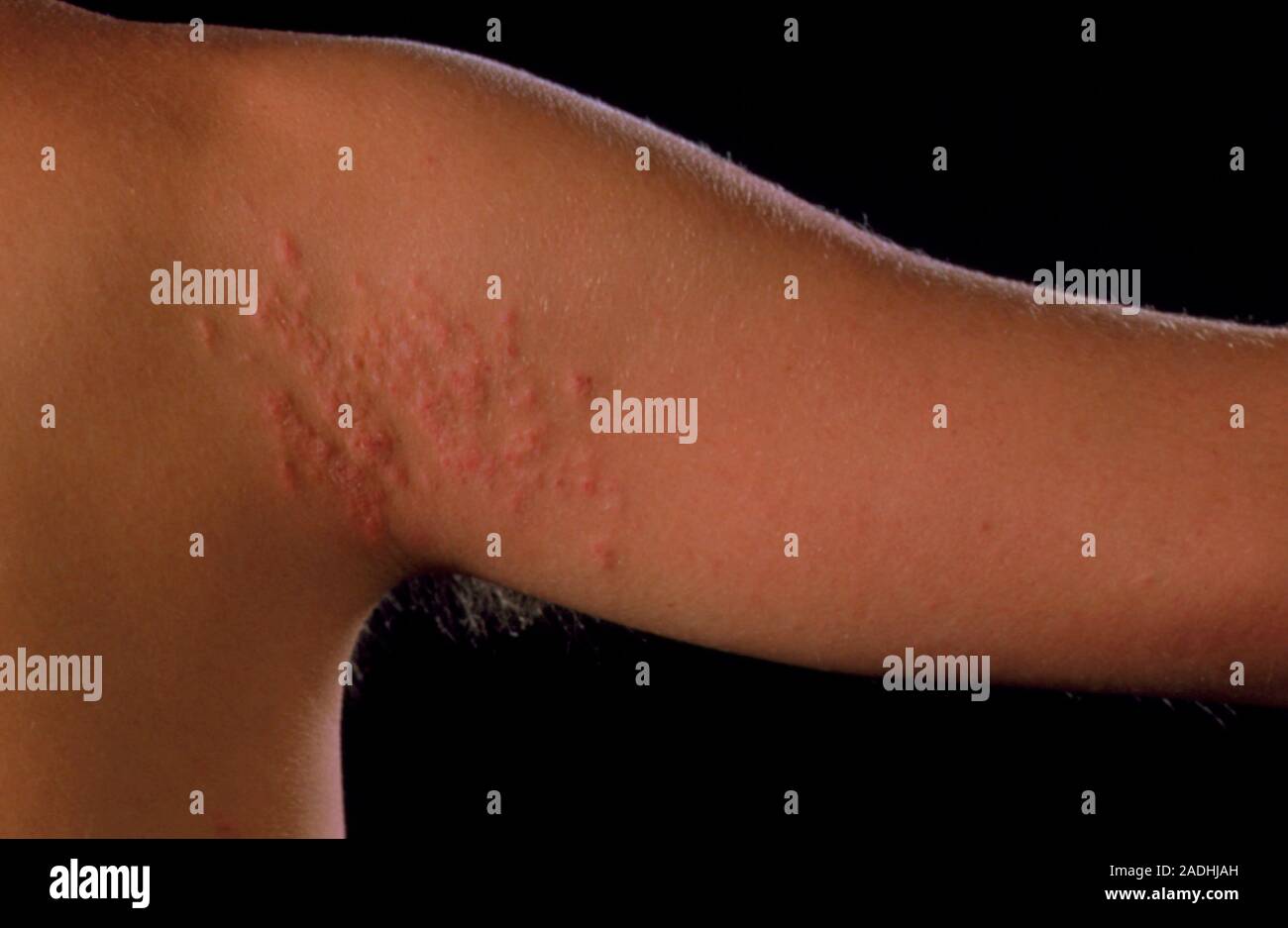 Cutaneous larva migrans, a skin rash on a young man's upper arm caused ...