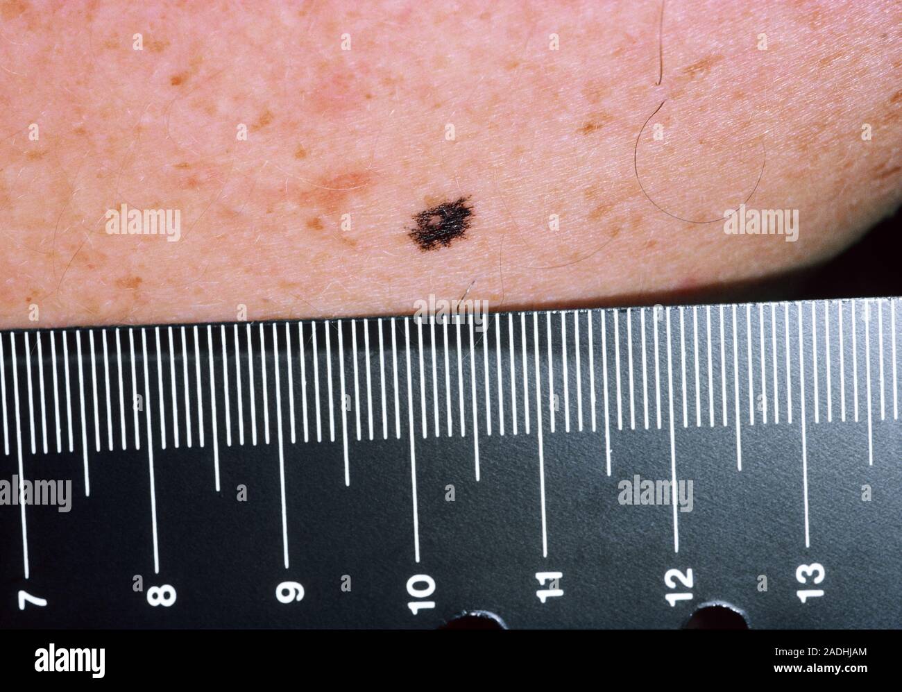 Lentigo. Close-up of the skin of a patient showing a liver spot or ...