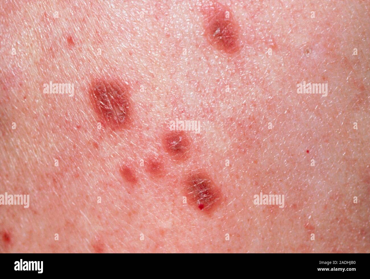 Causes Of Rash Purple