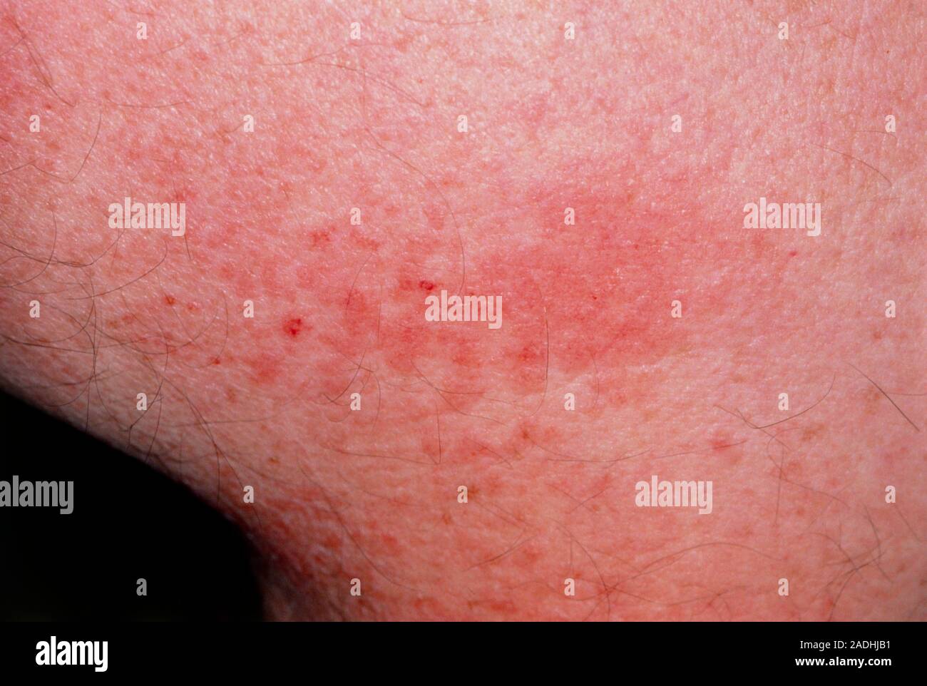 Lichen planus. Close-up of a skin rash consisting of multiple, raised ...