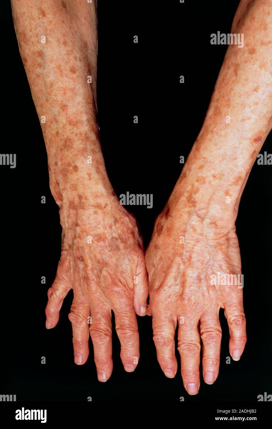 Lentigo. View of the forearms and hands of an elderly woman, showing ...