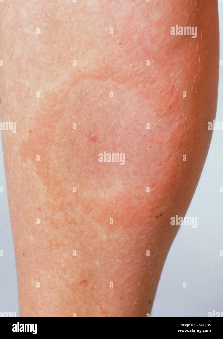 Lyme disease rash. A circular rash on a female patient's lower left leg known as Erythema ...