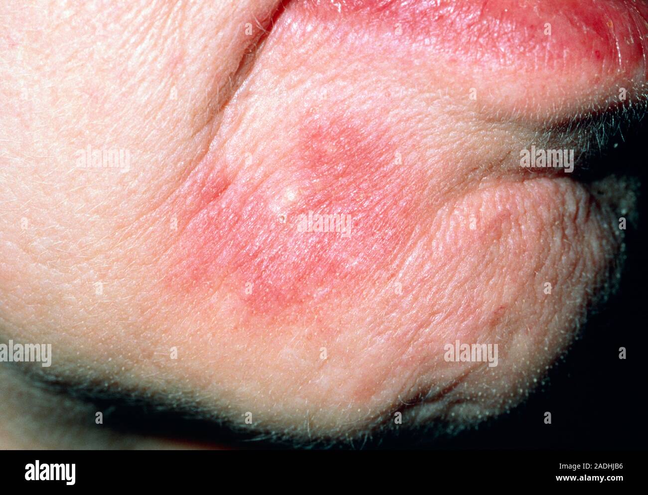 Systemic Lupus Erythematosis (SLE). View of a lesion caused by systemic ...