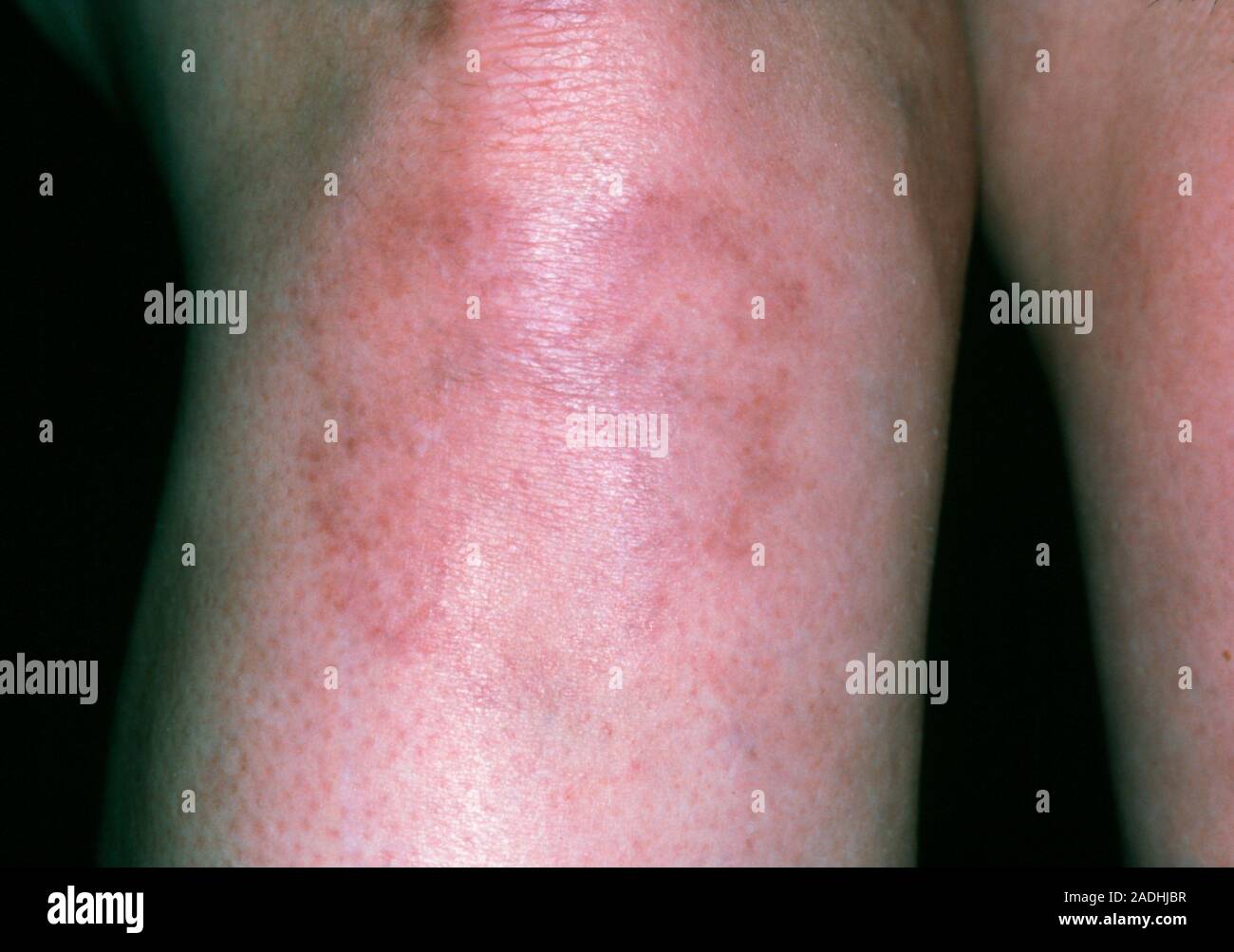 Systemic lupus erythematosus. A rash on the leg of a 45-year-old woman ...