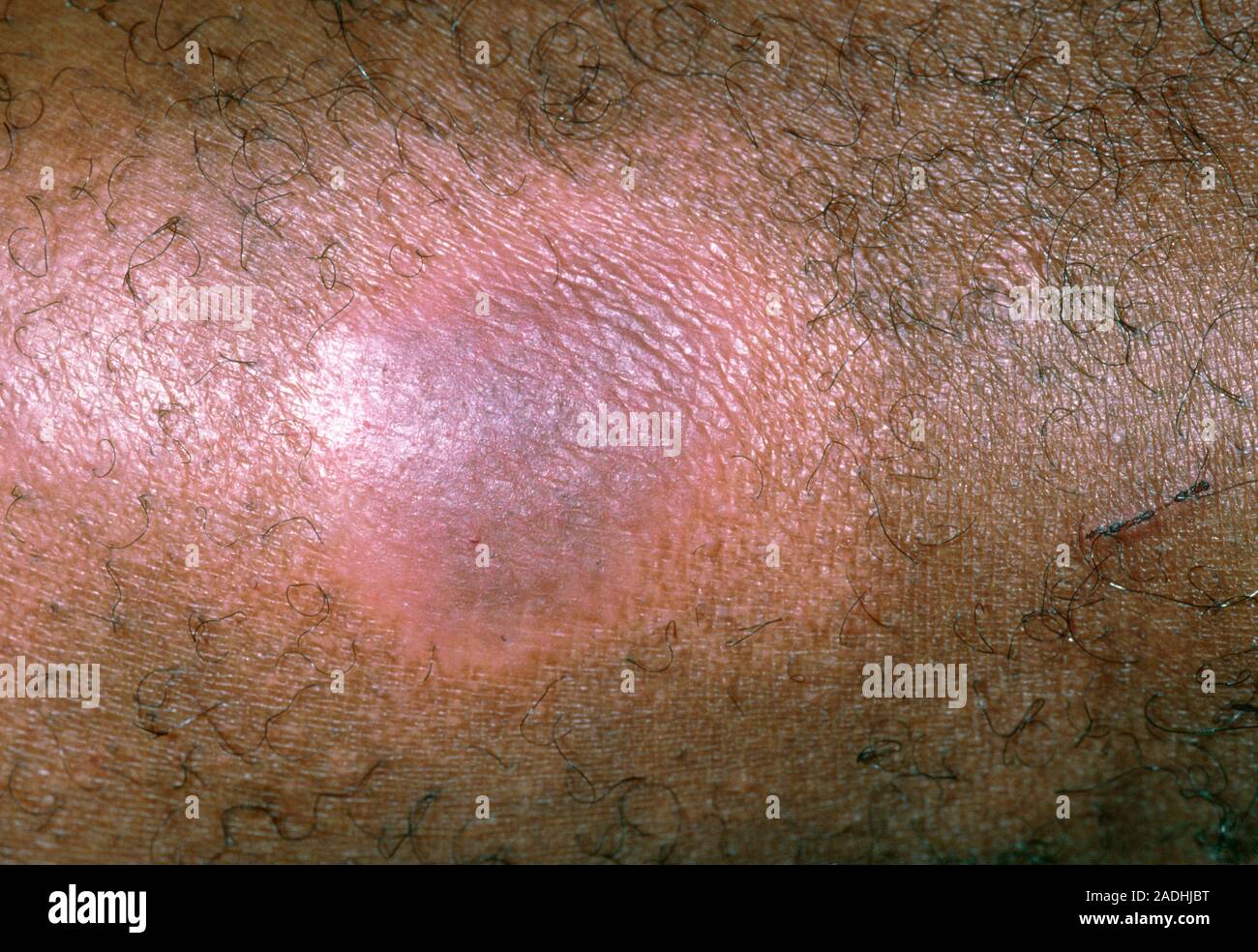 Lichen simplex rash on the skin of a 30-year-old black male. Lichen ...