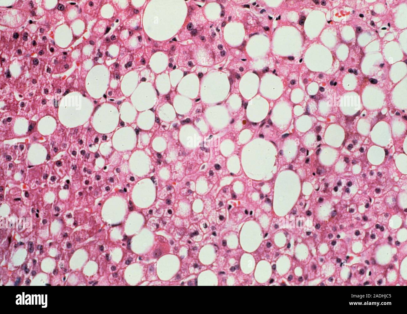 Fatty liver. Light micrograph of a section through the liver of an ...