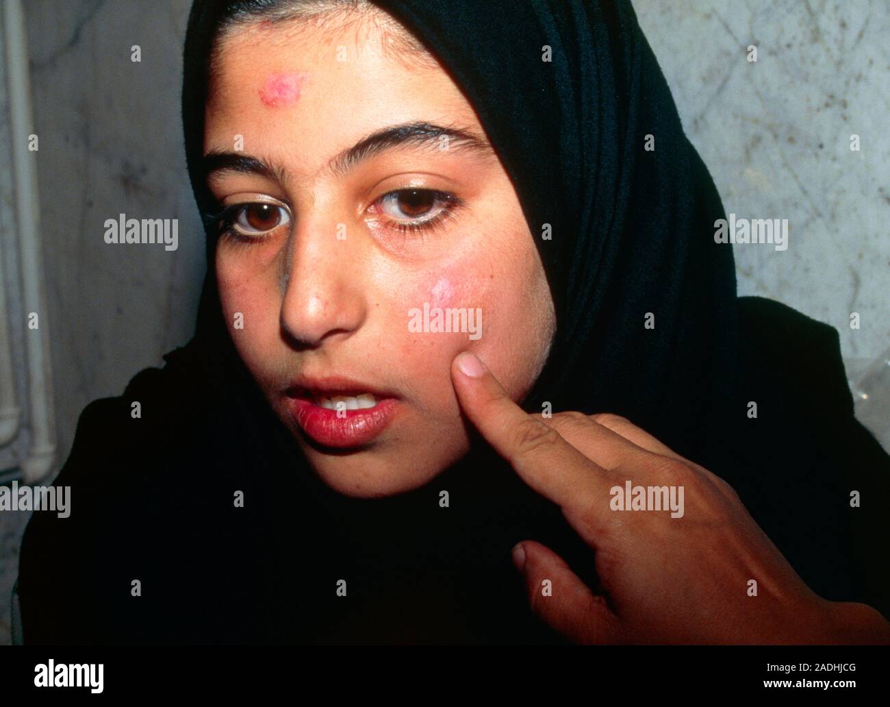 Cutaneous leishmaniasis. View of a secondary cutaneous leishmaniasis ...