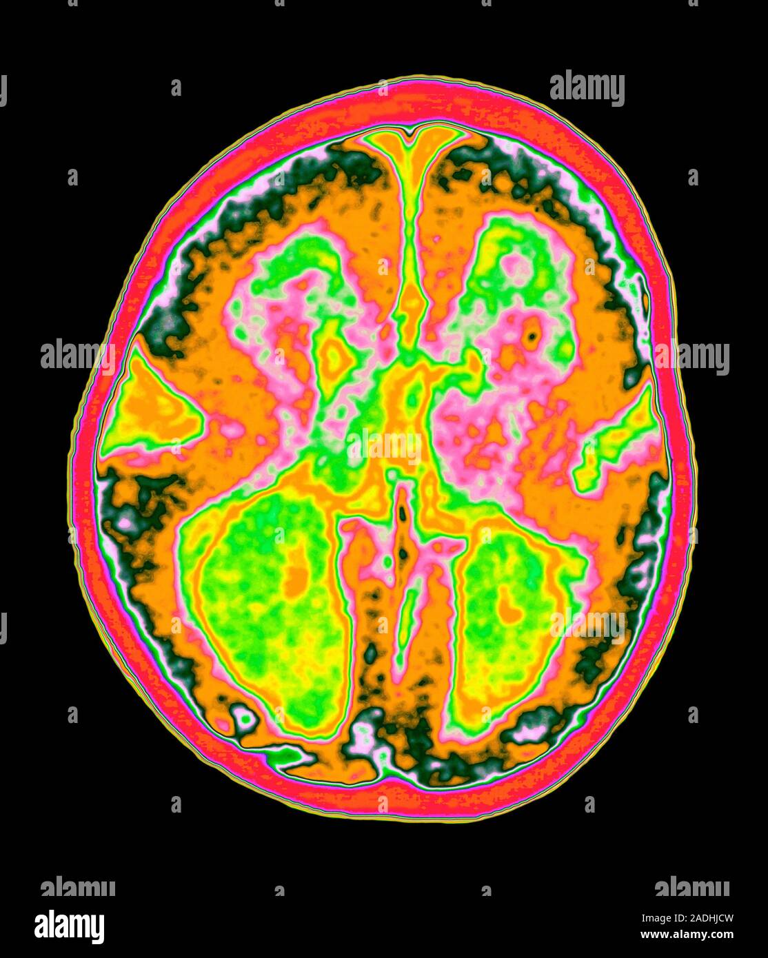 Lissencephaly. Coloured magnetic resonance imaging (MRI) scan of a ...