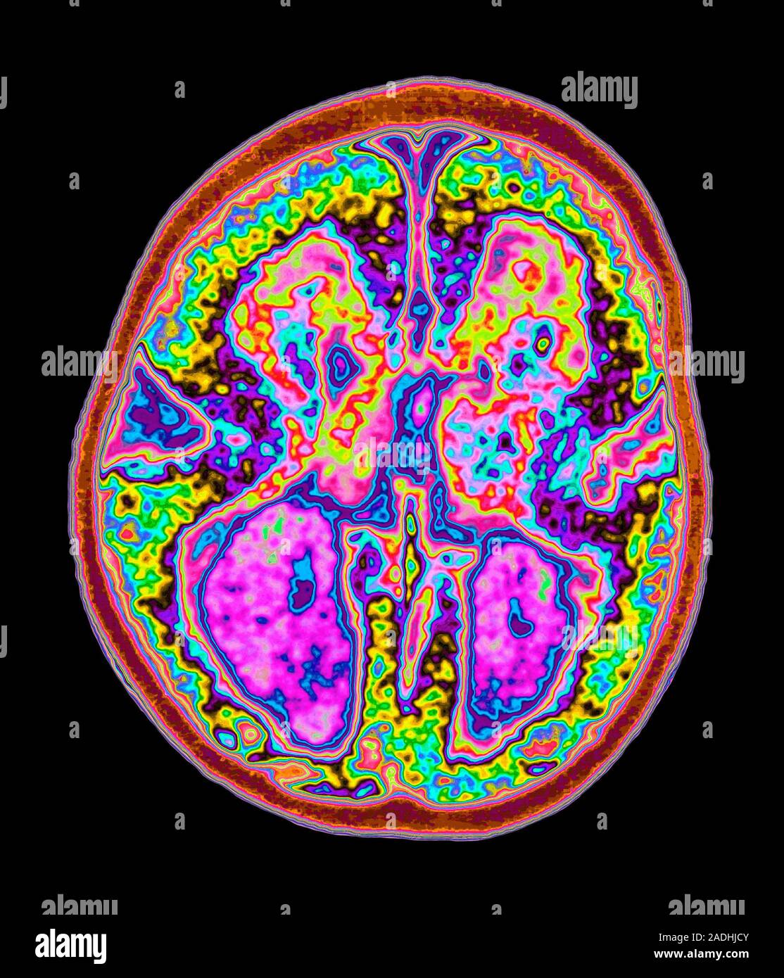 Lissencephaly. Coloured magnetic resonance imaging (MRI) scan of a ...