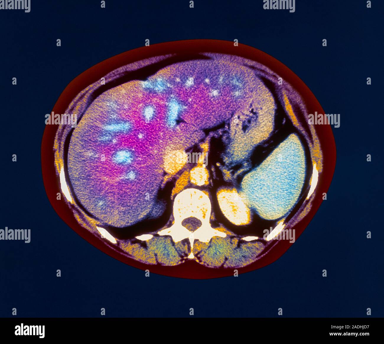 Fatty liver. Coloured computed tomography (CT) scan of an axial section ...