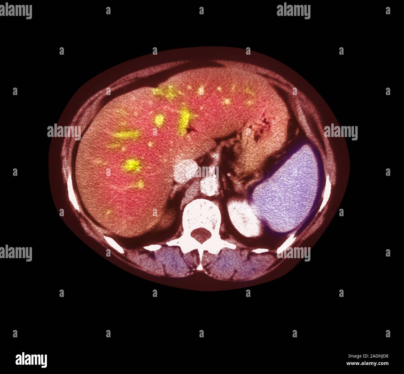 Fatty liver. Coloured computed tomography (CT) scan of an axial section through the abdomen of a ...