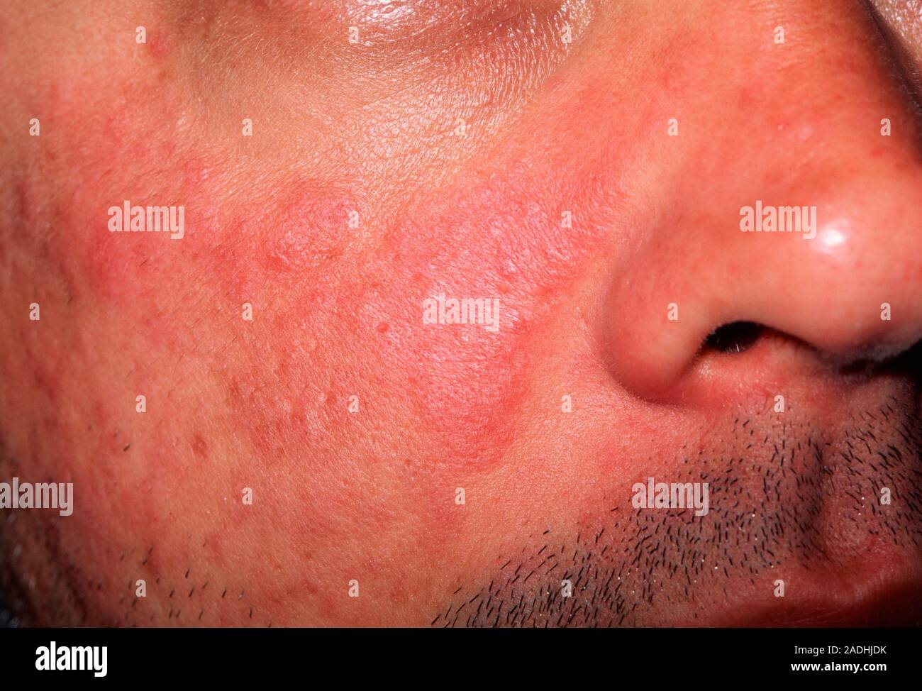 Lupus rash on the cheek of a 35-year-old man. He has systemic lupus ...