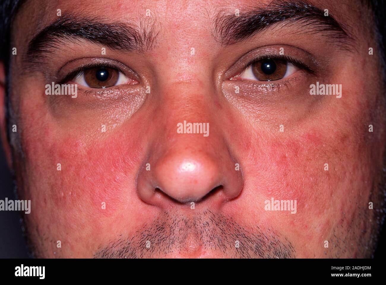 Lupus Rash On The Face Of A 35 Year Old Man He Has Systemic Lupus Erythematosus Sle One