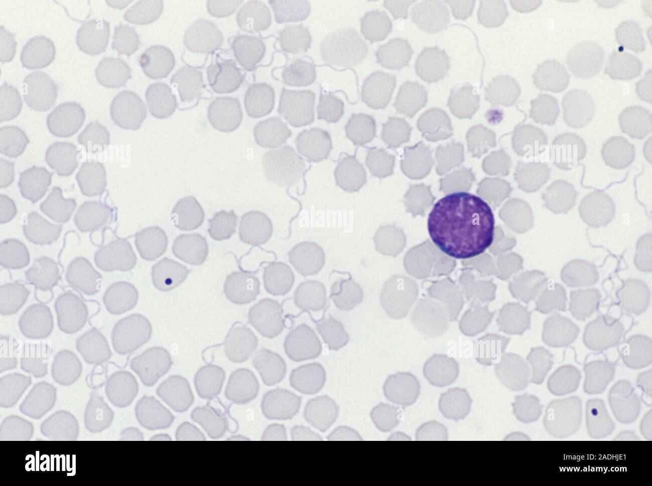 Lyme disease blood sample. Light micrograph of a blood smear showing ...