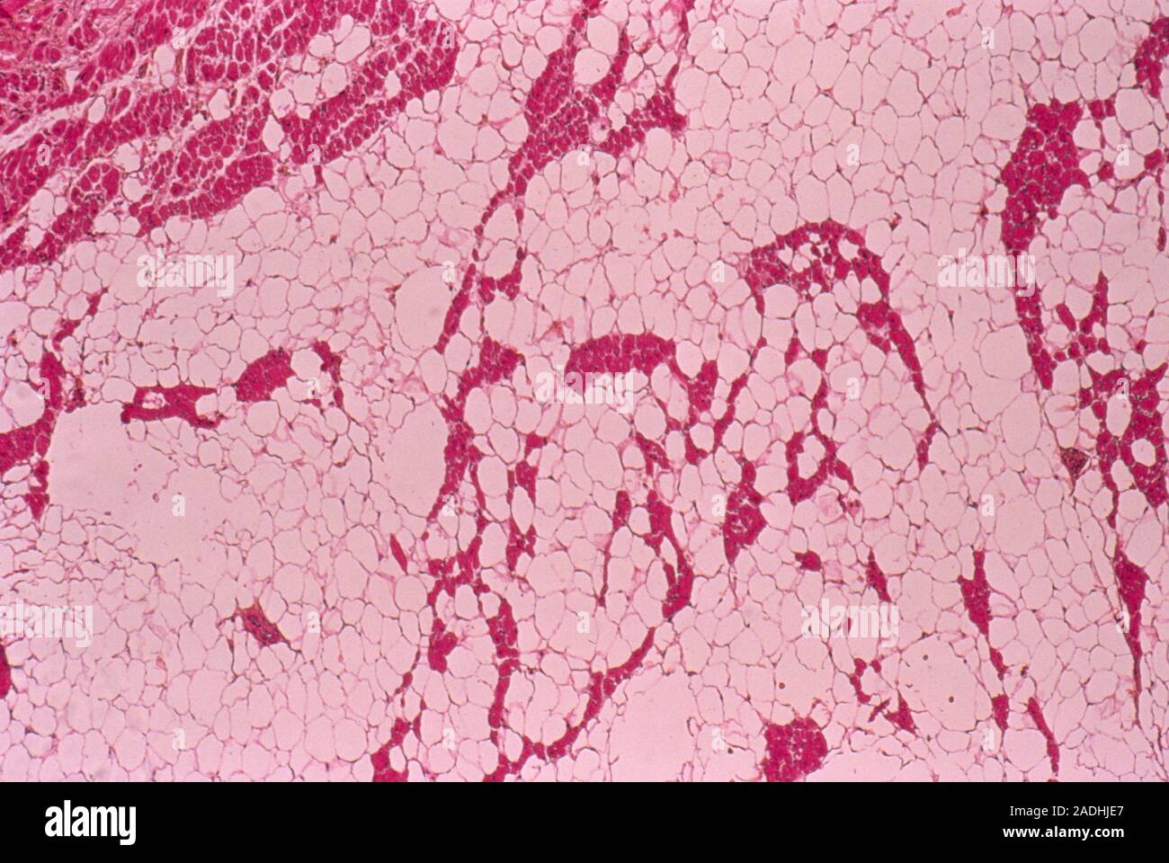 Lipoma tumour. Light micrograph of a section through a lipoma from the ...