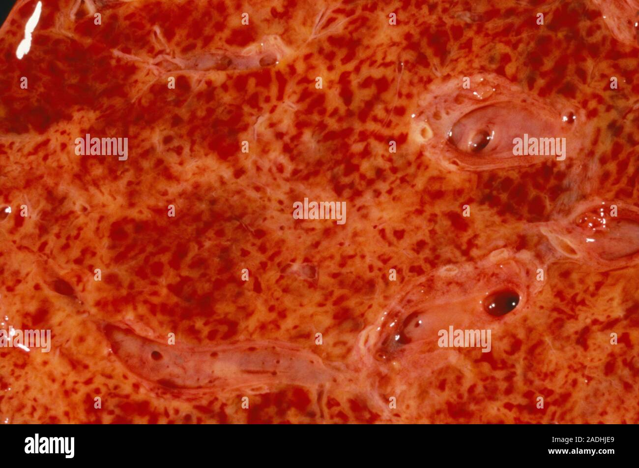 Lupoid hepatitis. Gross specimen of tissue from a liver in a case of ...