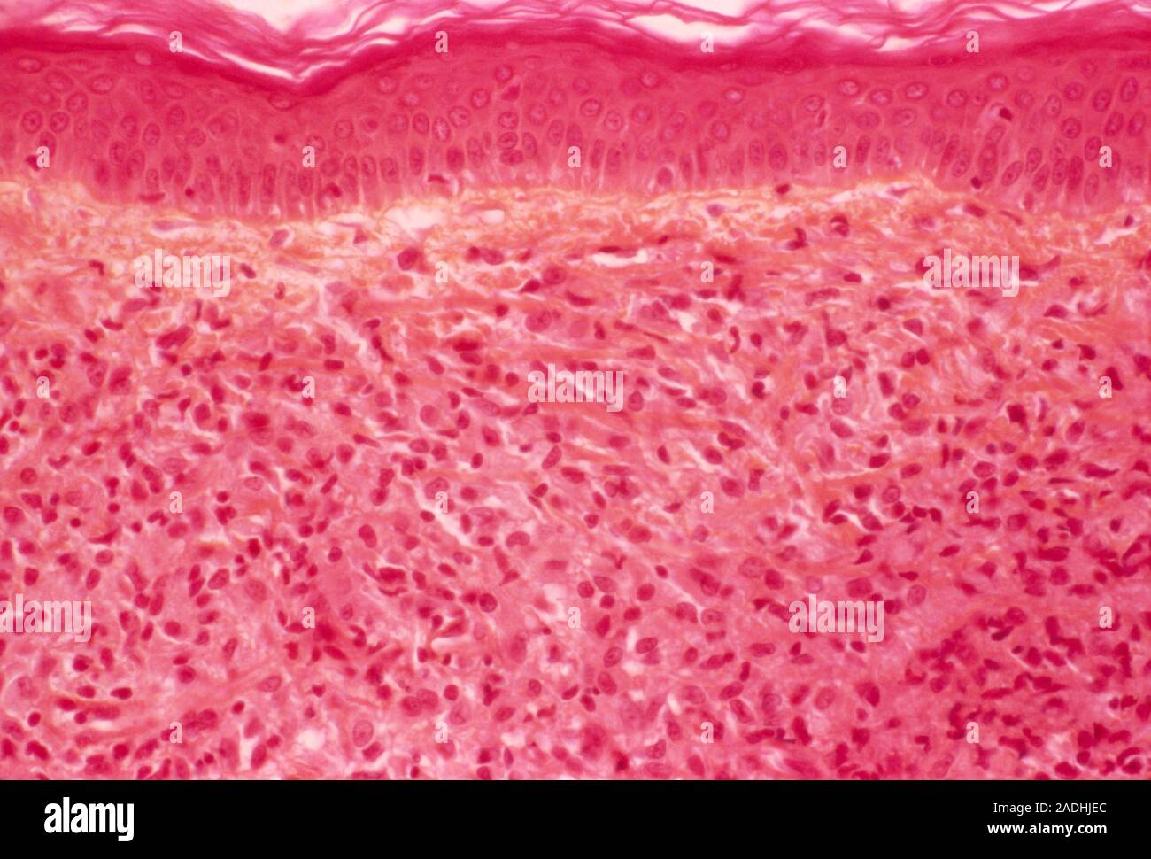 Leprosy skin lesion. Light micrograph of a section through human skin ...