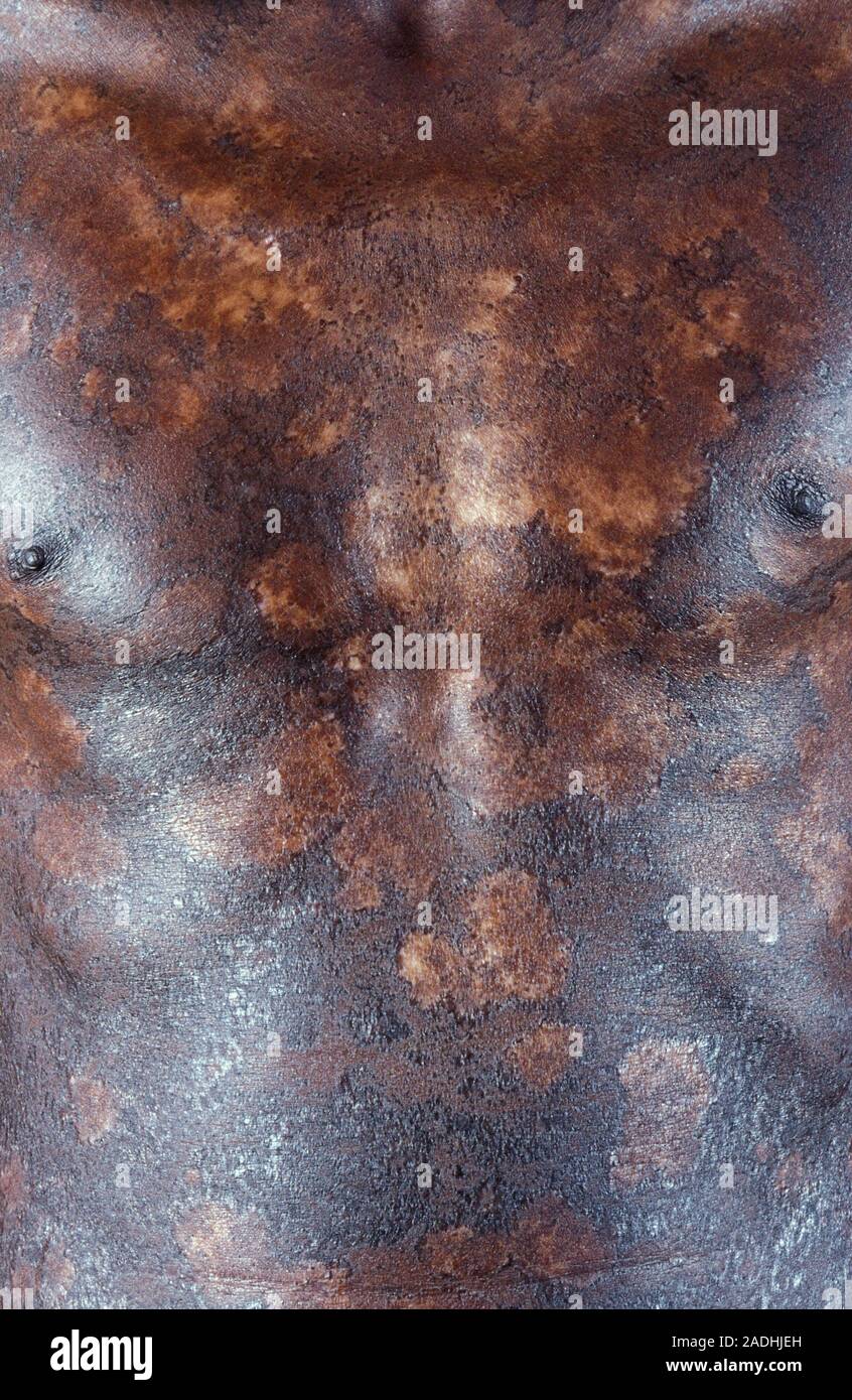 Lichen planus skin disease. Lesions on the torso of a male patient in a ...