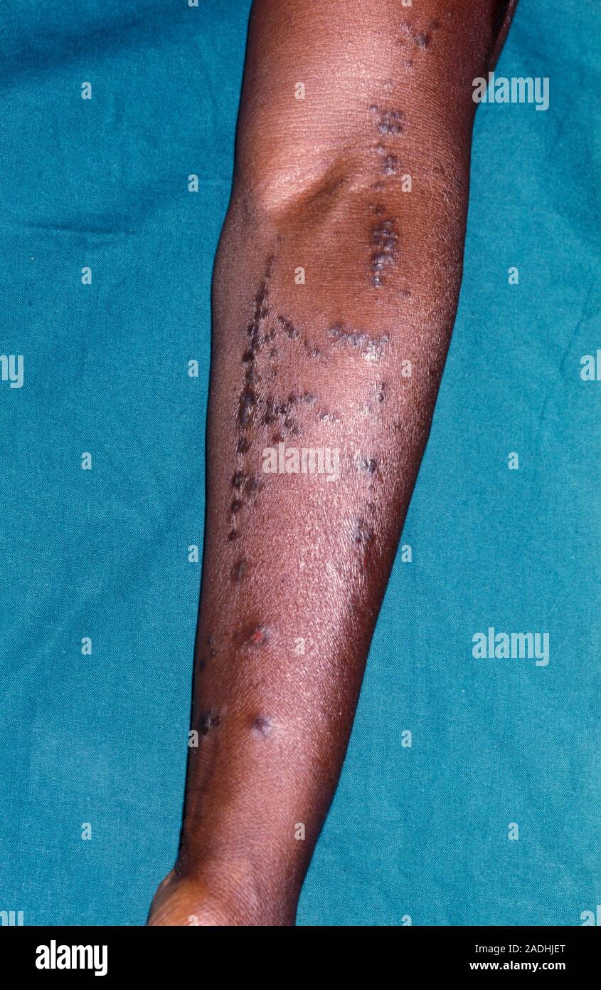 Lichen planus lesions on a patient's arm. This skin disease is ...