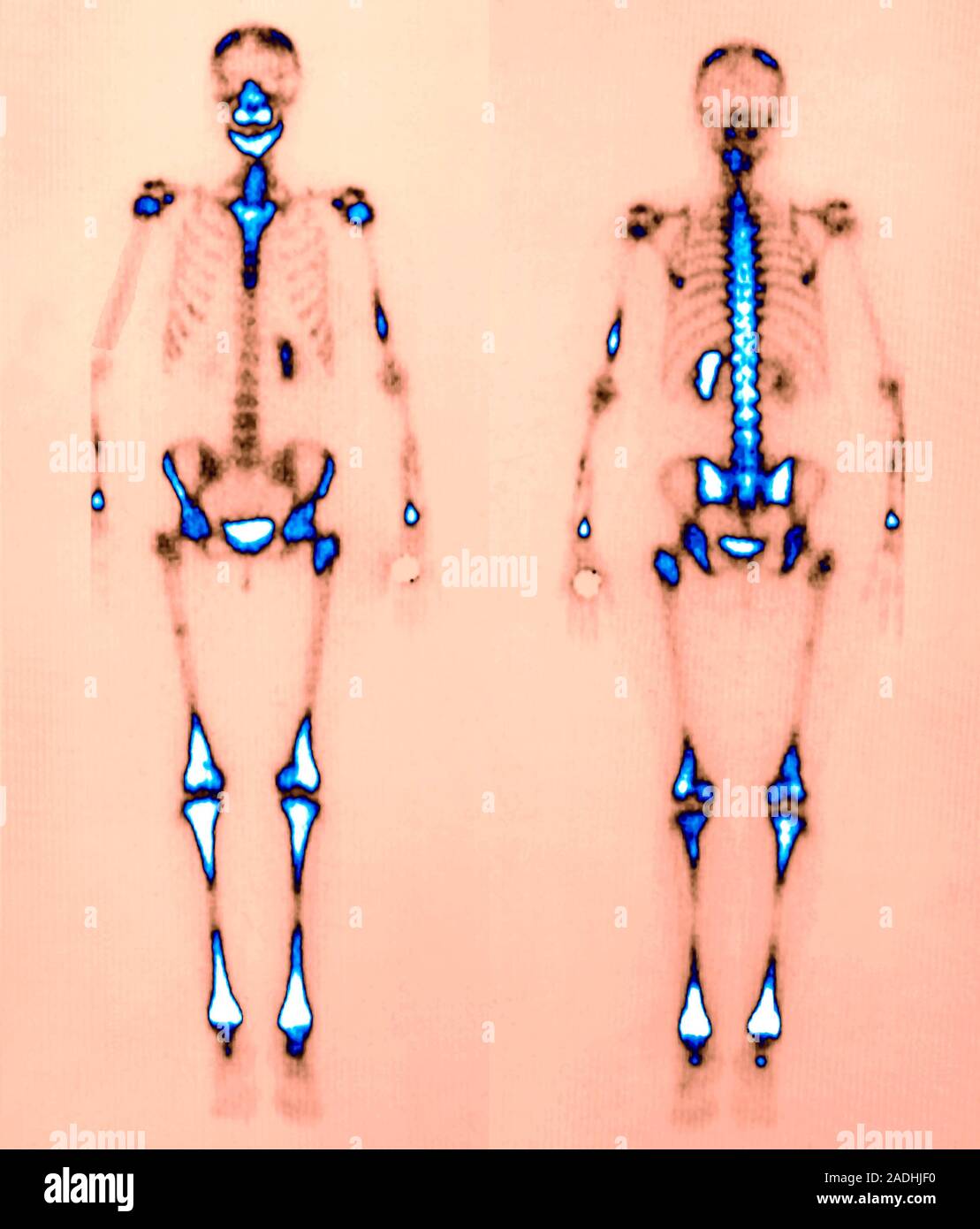 Langerhans cell histiocytosis. Coloured scintigram of the front (left) and back of the skeleton ...