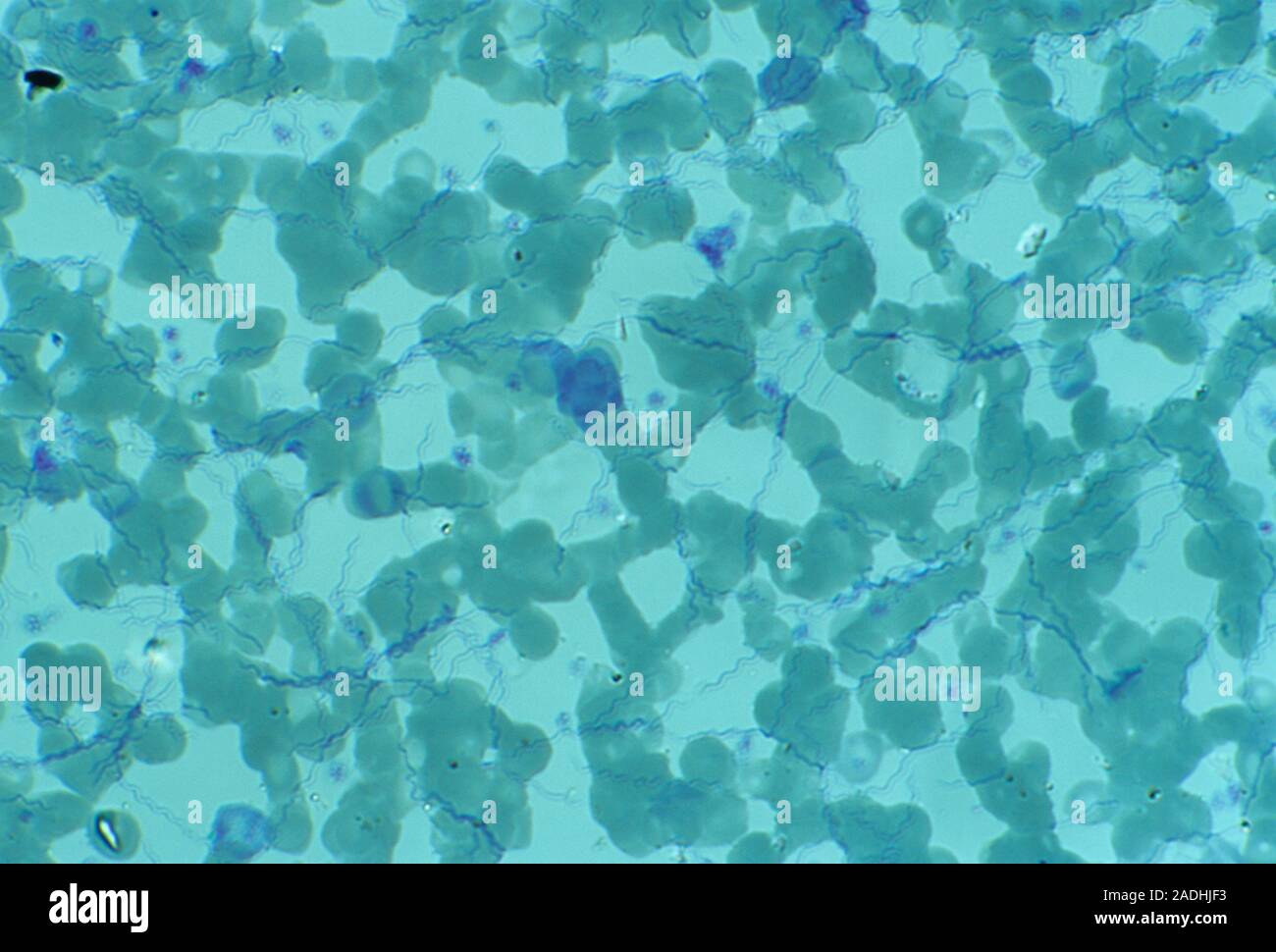 Lyme disease. Light micrograph of a blood sample from a patient with ...