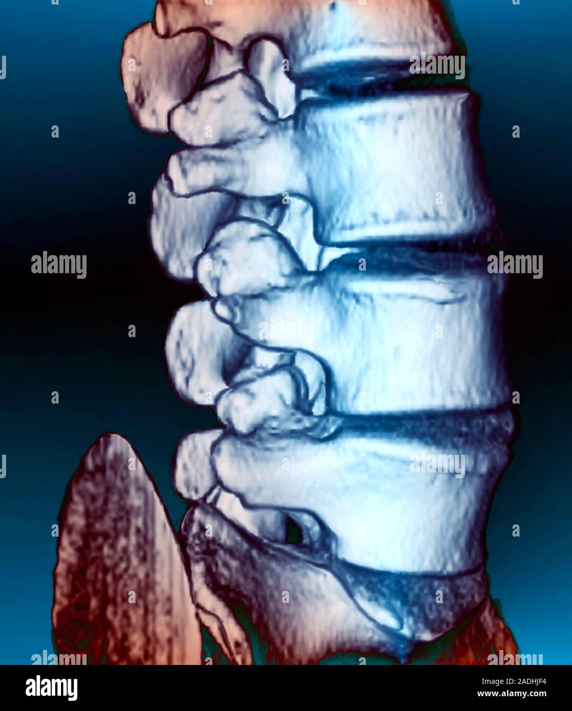 Spine disorder. Sagittal coloured 3D magnetic resonance imaging (MRI ...