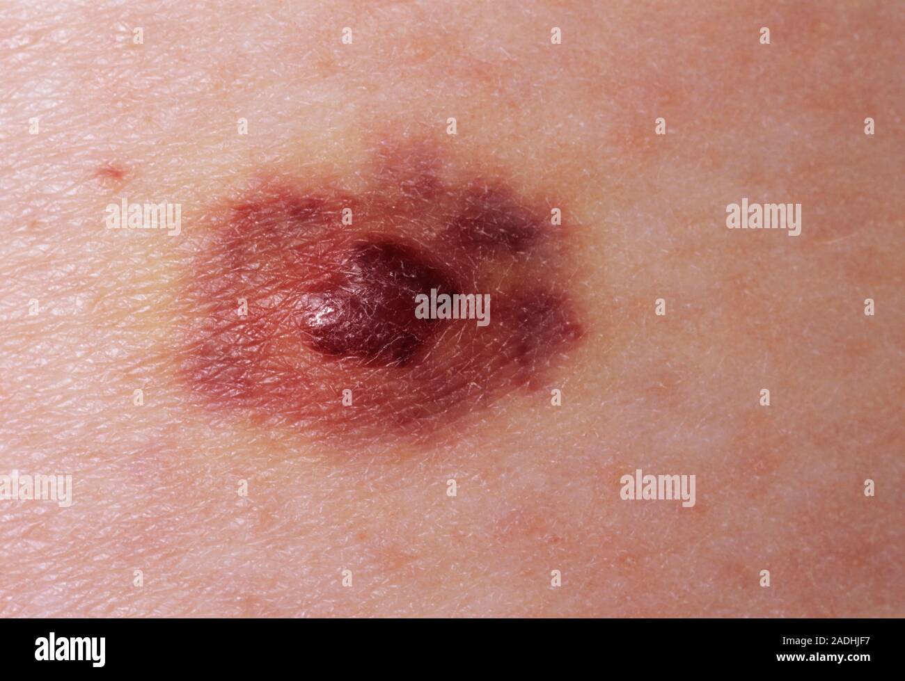 Benign lymphangioma on the skin of a 44-year-old woman. This rare ...