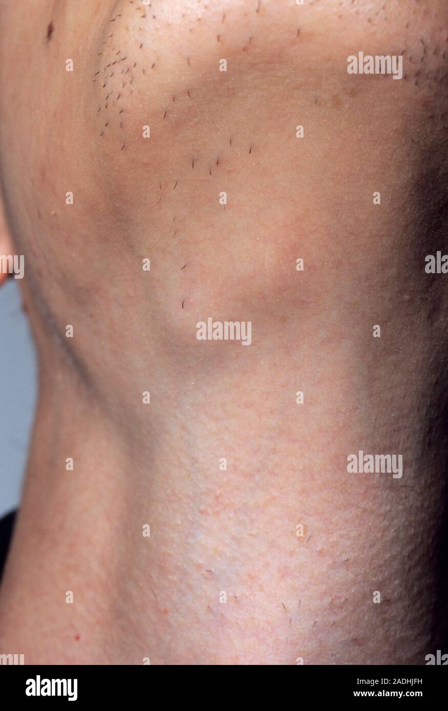 Swollen gland under the chin of a 27-year-old alcoholic man. This ...