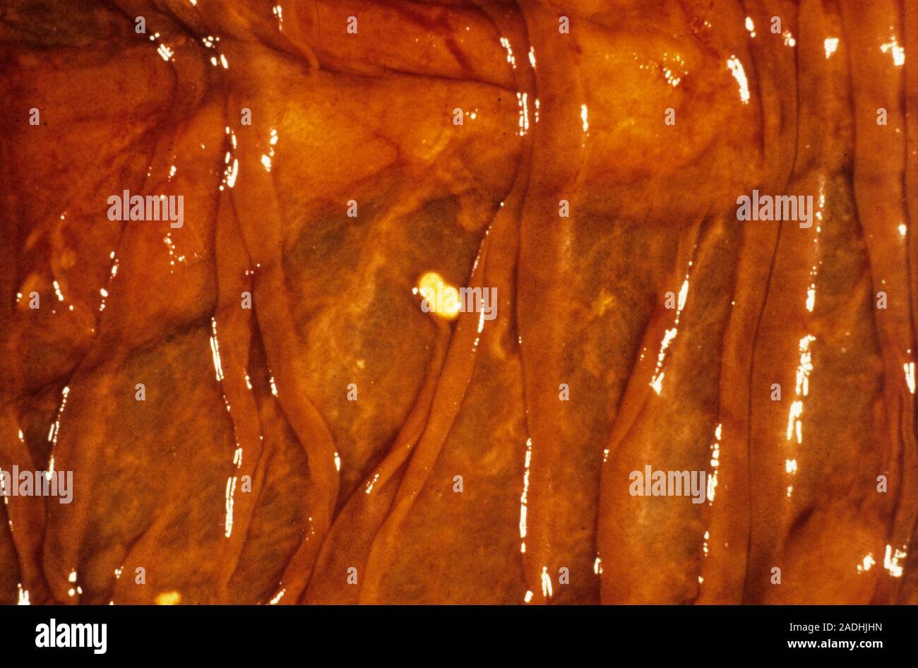 Swollen lymphatic vessels (running vertically) in the colon, a ...
