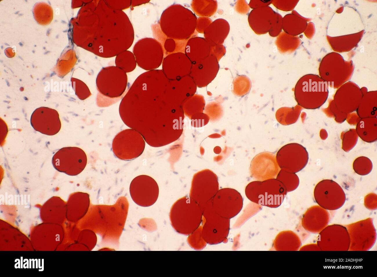 Lipoma tumour, light micrograph. A lipoma is a benign (non-cancerous ...