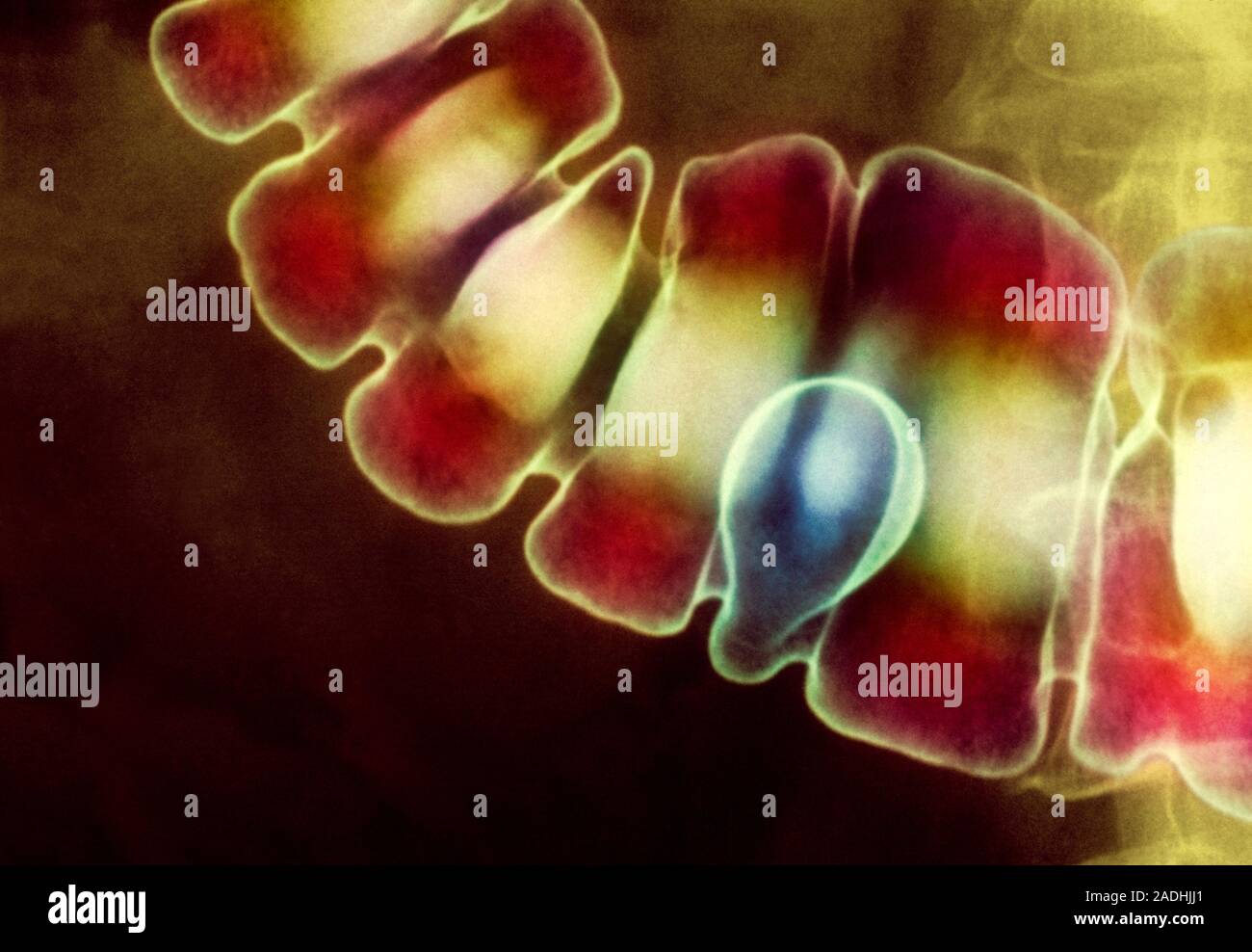 Lipoma in the colon. Coloured X-ray of a lipoma (bulbous shape, lower ...