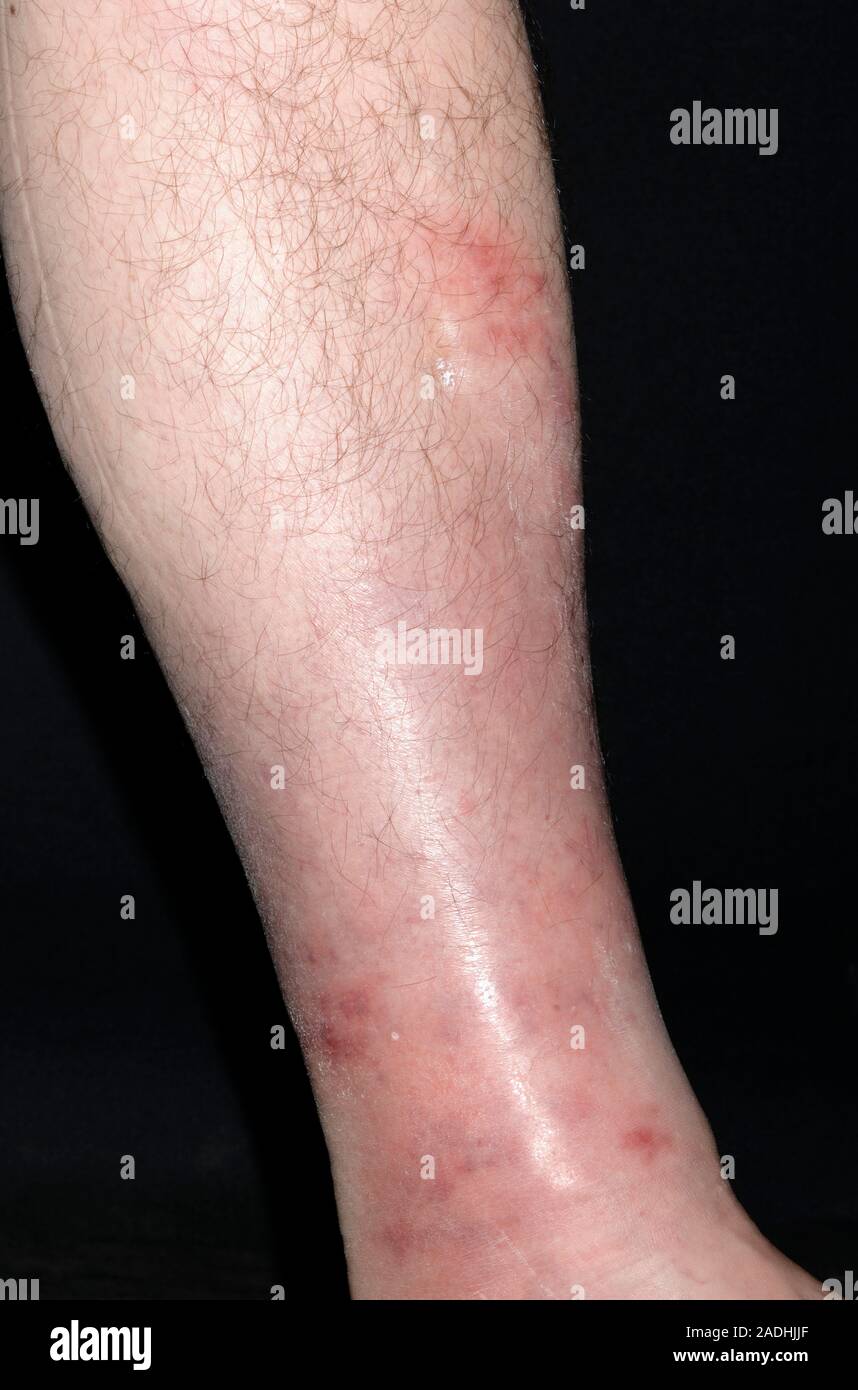 Infected lymphoedema in the leg of a 59 year old man. A lymphoedema ...