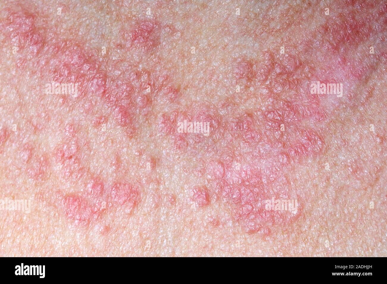 Lupus rash. Rash on a 51 year old woman's chest caused by systemic ...